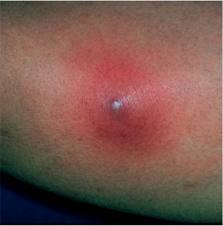 BIOLOGIA CULTURA E INFORMAÇÃO: Furúnculo Causas e Tratamento