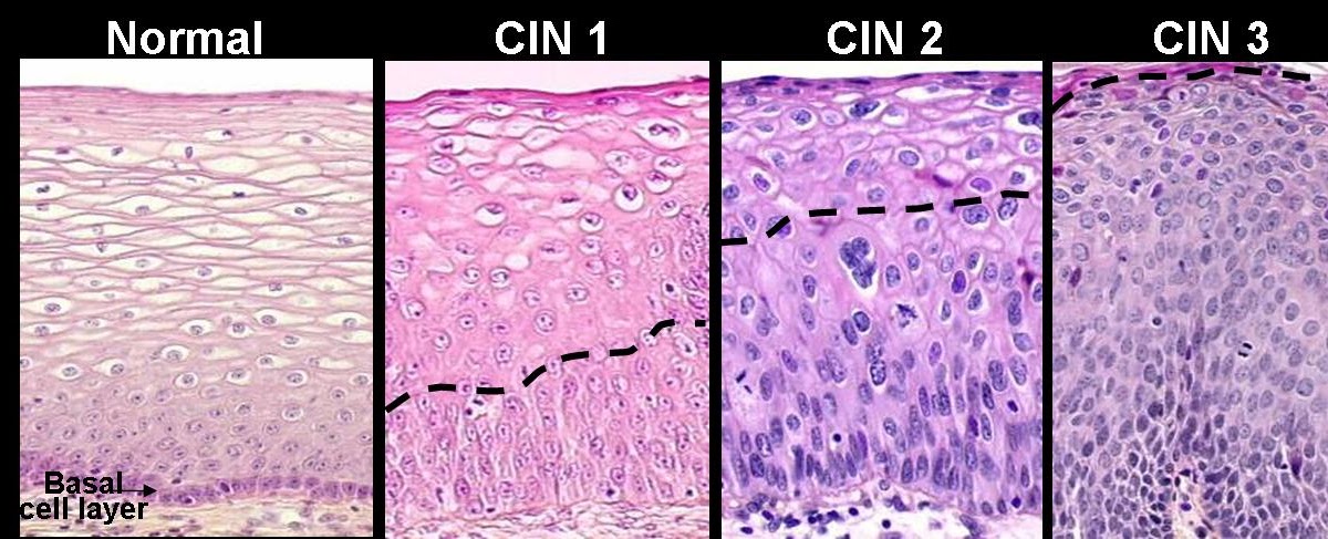 QUE ES UNA DISPLASIA CERVICAL? | Tu salud primero