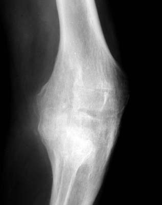 Carolina: Artritis, Enfermedades de las articulaciones.