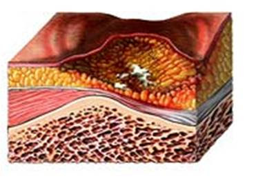 Enfermagem"C": FERIDAS CLASSIFICAÇÕES E COMPLICAÇÔES -Prof-Hélia ...