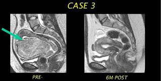 CT/MRI procedures: Uterine Fibroids