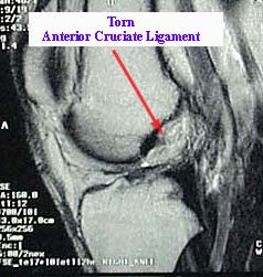 CT/MRI procedures: Anterior Cruciate Ligament (ACL) tear