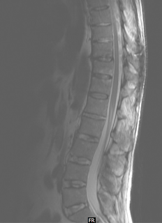 Andersson lesion-Ankylosing Spondylitis - Sumer's Radiology Blog