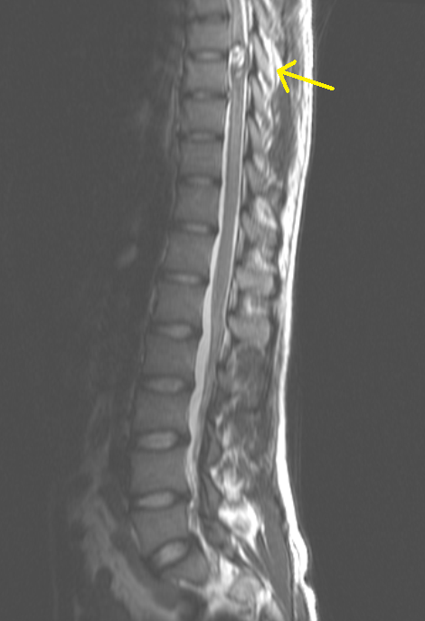 Intramedullary Cavernoma-MRI - Sumer's Radiology Blog