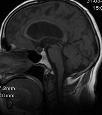 Normal Pressure Hydrocephalus-MRI - Sumer's Radiology Blog