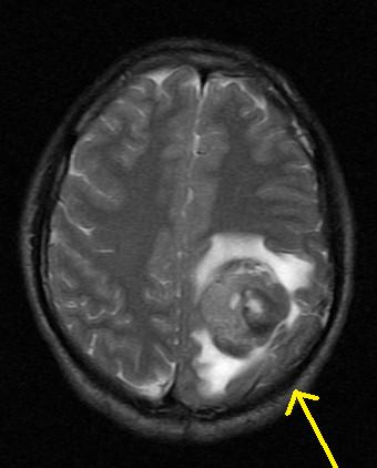 Large Intracerebral Cavernoma - Sumer's Radiology Blog