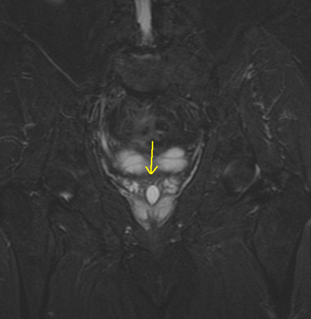 Müllerian Duct Cysts and Prostatic Utricle Cysts - Sumer's Radiology Blog