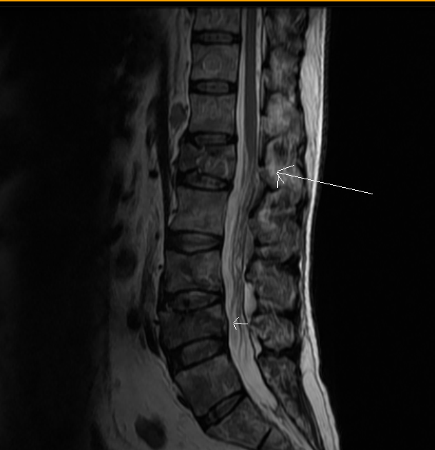 Spinal metastatic disease-MRI - Sumer's Radiology Blog