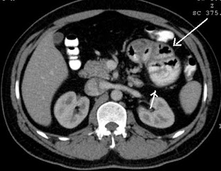 Paraduodenal Hernia-CT - Sumer's Radiology Blog