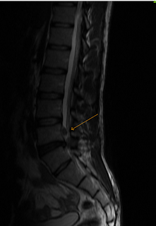 Sequestered disk-MRI - Sumer's Radiology Blog