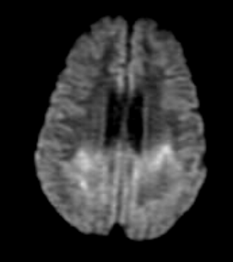 ADRENOLEUKODYSTROPHY-MRI - Sumer's Radiology Blog