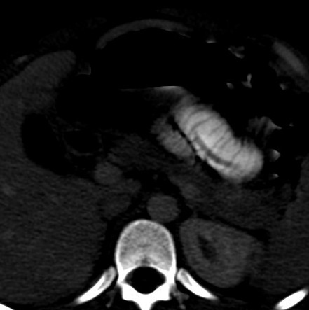 Ascariasis-CT - Sumer's Radiology Blog