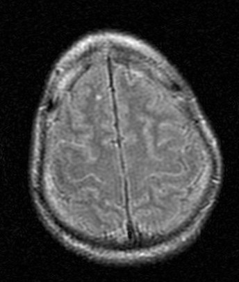 Diffuse Axonal Injury-MRI - Sumer's Radiology Blog