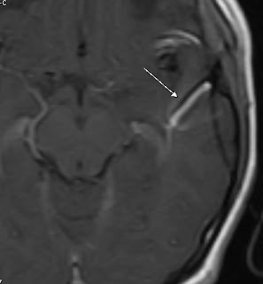 Venous Angioma-MRI - Sumer's Radiology Blog