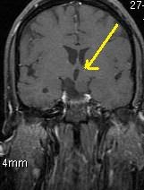 Tuber cinereum hamartoma-MRI - Sumer's Radiology Blog