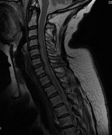 Anterior Spinal Cord Infarction-MRI - Sumer's Radiology Blog