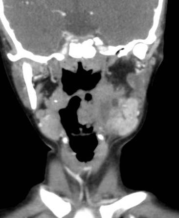 Plunging Ranula Ultrasound