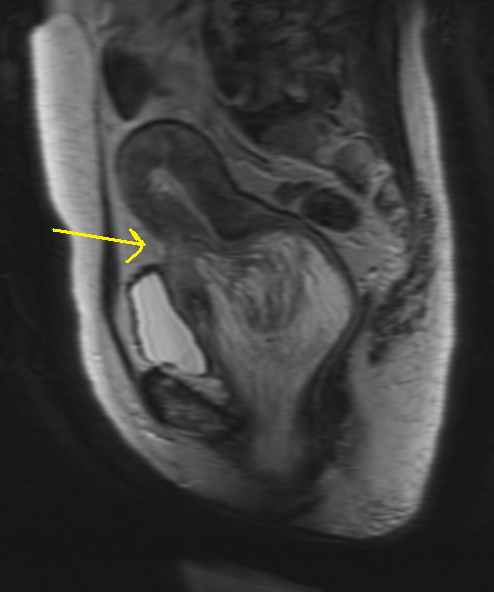 Gynecological MRI- Two Cases - Sumer's Radiology Blog