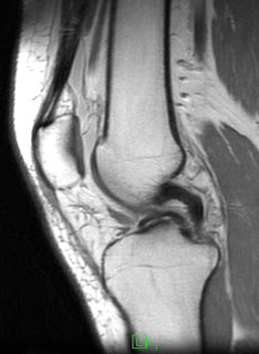 Bucket Handle Meniscal Tear-MRI - Sumer's Radiology Blog