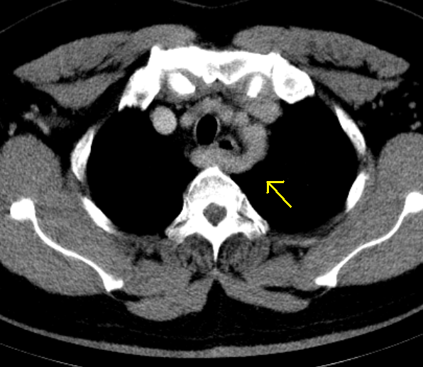 Aberrant Right Subclavian Artery and Dysphagia Lusoria-CT - Sumer's ...