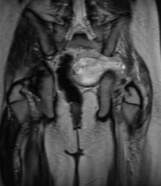 Sciatic Schwannoma-MRI - Sumer's Radiology Blog