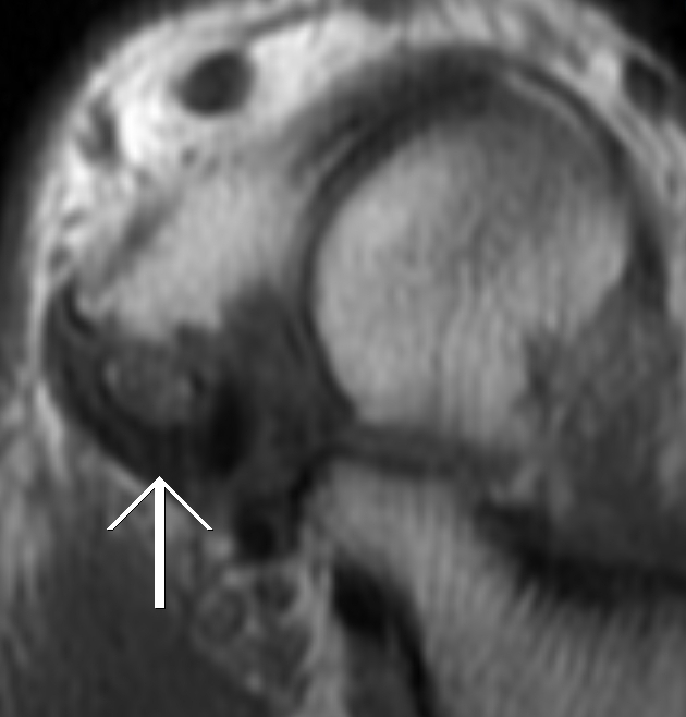 Os Navicularis Syndrome-MRI - Sumer's Radiology Blog