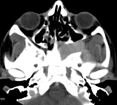 Juvenile angiofibroma-CT - Sumer's Radiology Blog