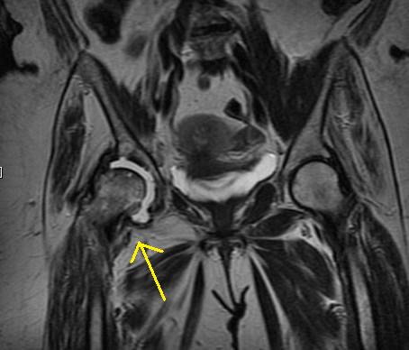 Rheumatoid Arthritis- Hip - Sumer's Radiology Blog