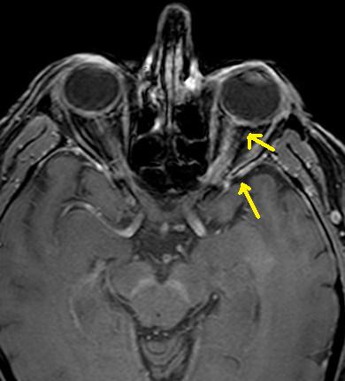 Optic Neuritis-MRI - Sumer's Radiology Blog