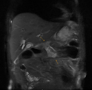 Pancreatic Transection-MRI - Sumer's Radiology Blog