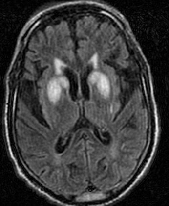 Hypoglycemic Encephalopathy-MRI - Sumer's Radiology Blog