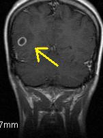 DWI- intracranial tuberculoma & tuberculous abscess versus cysticercus ...