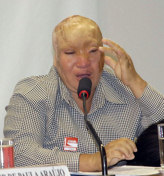 Roberta - Segurança do Trabalho: Escalpo ou Escalpelamento! Você Sabe ...