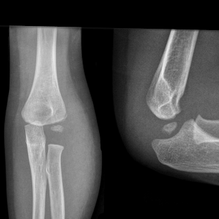 Utah Pediatric Radiology: Case of the week: 29 month old with elbow pain