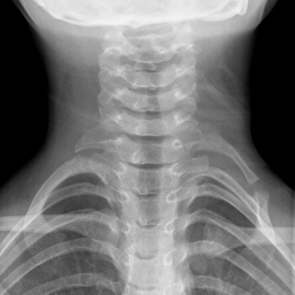 Utah Pediatric Radiology: Case of the Week: Hard left supraclavicular mass