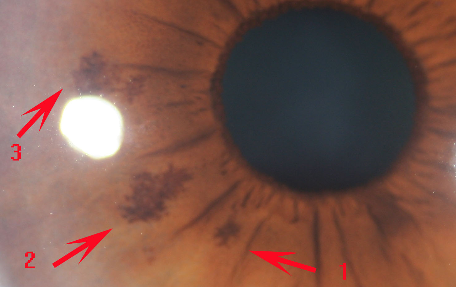 Modern & Multidimensional Iridology: Iridology Analysis - 46- Part 1