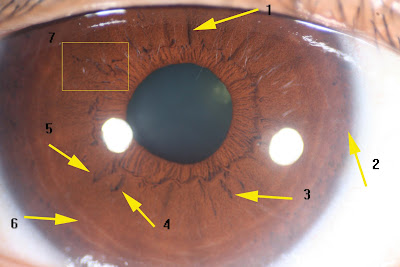 Modern & Multidimensional Iridology: Iridology Analysis- 28