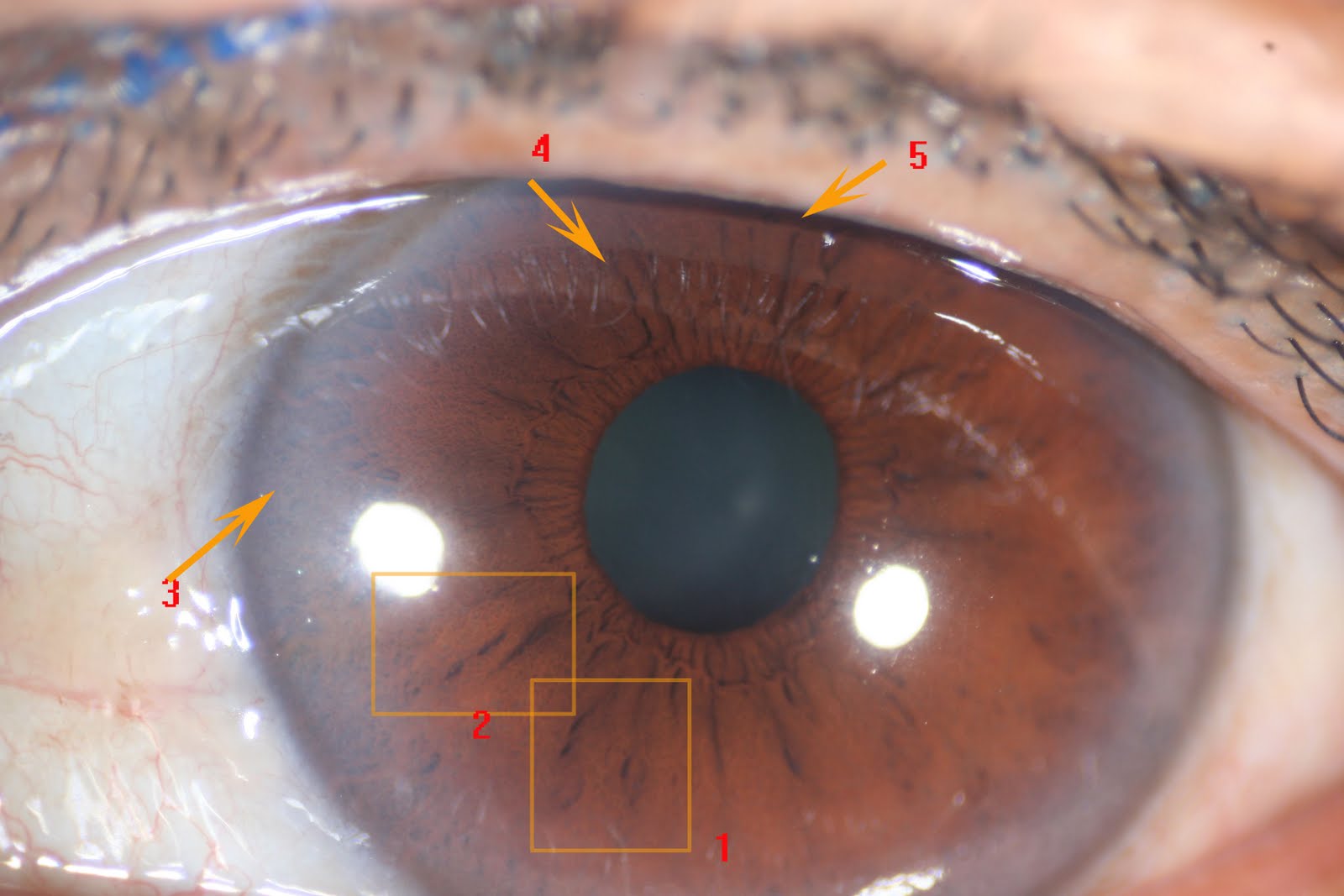 Modern & Multidimensional Iridology: Iridology Analysis - 42