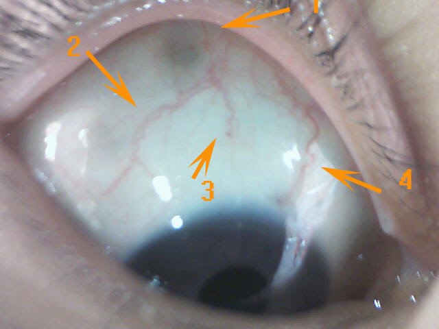 Modern & Multidimensional Iridology: Sclerology Analysis -33