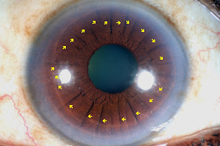 Modern & Multidimensional Iridology: Radial Furrows \ Radii Solaris