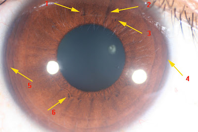 Modern & Multidimensional Iridology: Iridology Analysis- 15