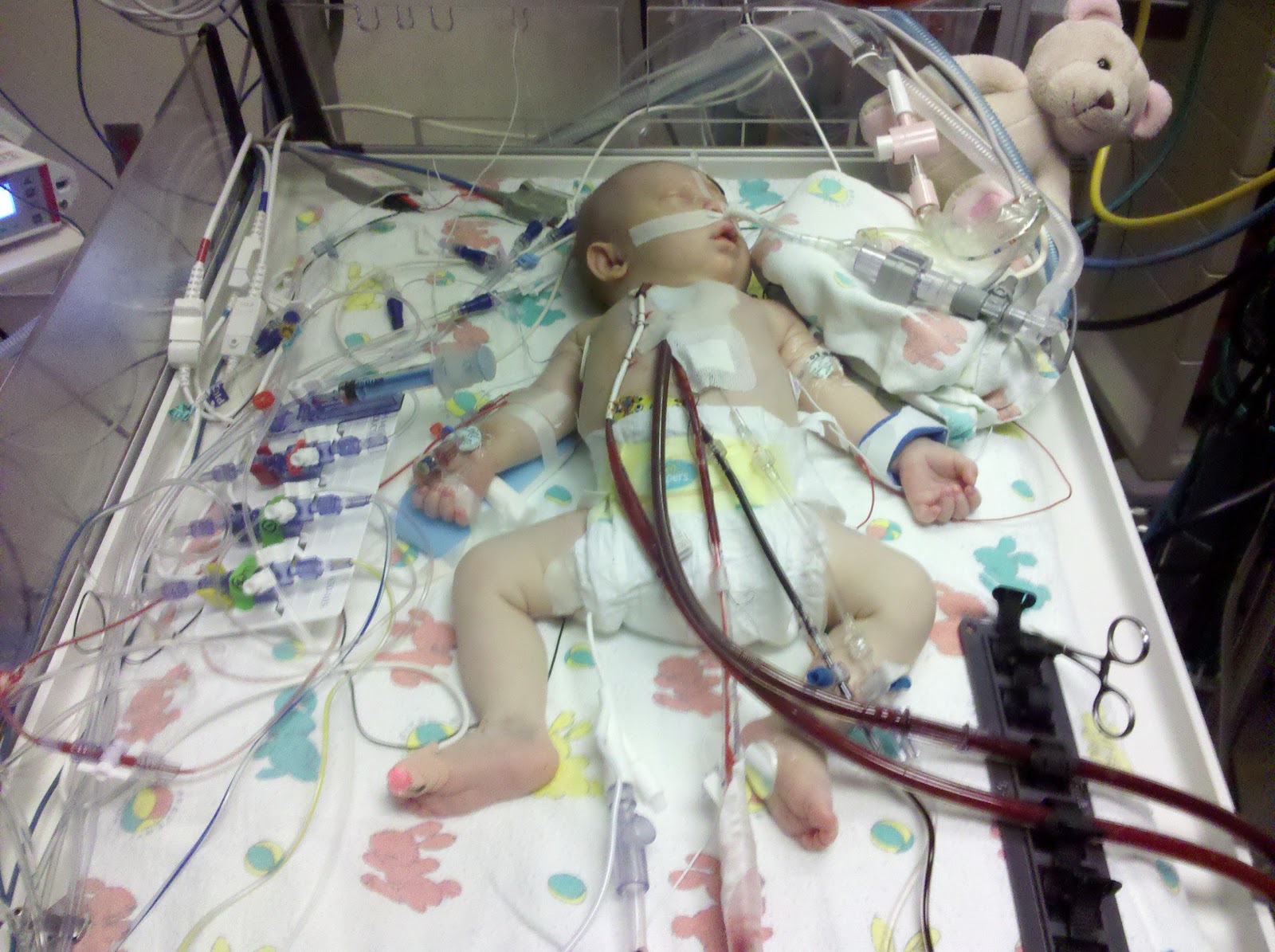 Lillian's Heart Journey: The Norwood - Lillian's First Open Heart Surgery