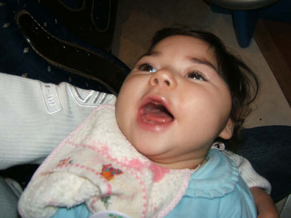 ENFERMEDADES ESPECIALES: Microcefalia desde el nacimiento