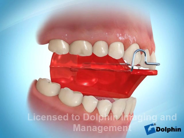 doctors videos backup: Dentistry: Bionator [HQ]