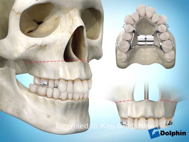 doctors videos backup: Dentistry: Surgically Assisted Palatal Expansion ...