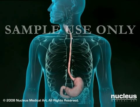 Doctors videos: Endoscopy :Upper GI (Gastrointestinal) Endoscopy for ...