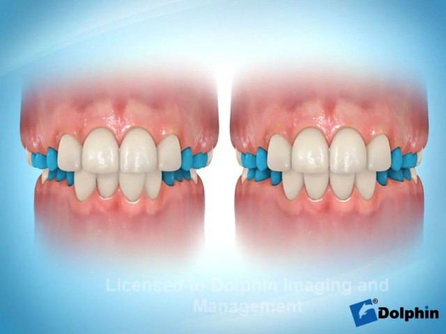 doctors videos backup: Dentistry: Mandibular Expander (Removable)