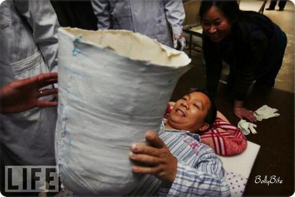 Amazing Pics: {SamsoNgroup} Half Man - The Story of Peng Shuilin