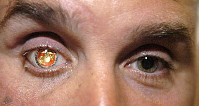 Prosthetic eye embedded with the Marine Corps emblem