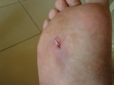 Puncture Wound Accident | Blackdove Nest